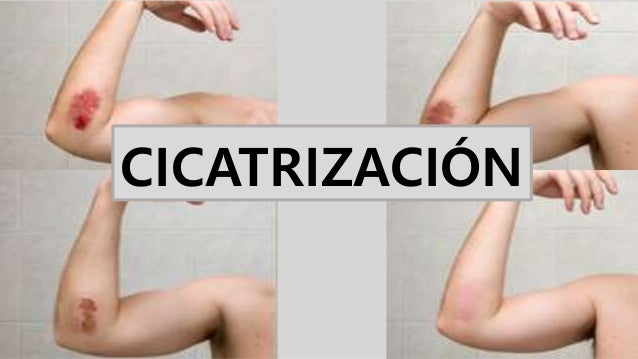 Que Es Una Cicatrizacion – Fisiología de la cicatrización cutánea ...