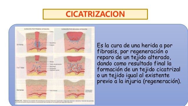 CICATRIZACION DE LAS HERIDAS