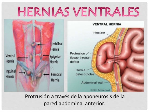 hernias de la pared abdominal – PZGI