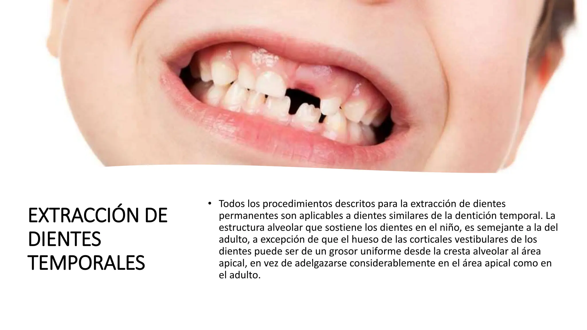exodoncia de erupcion de dientes ectopicos | PPT