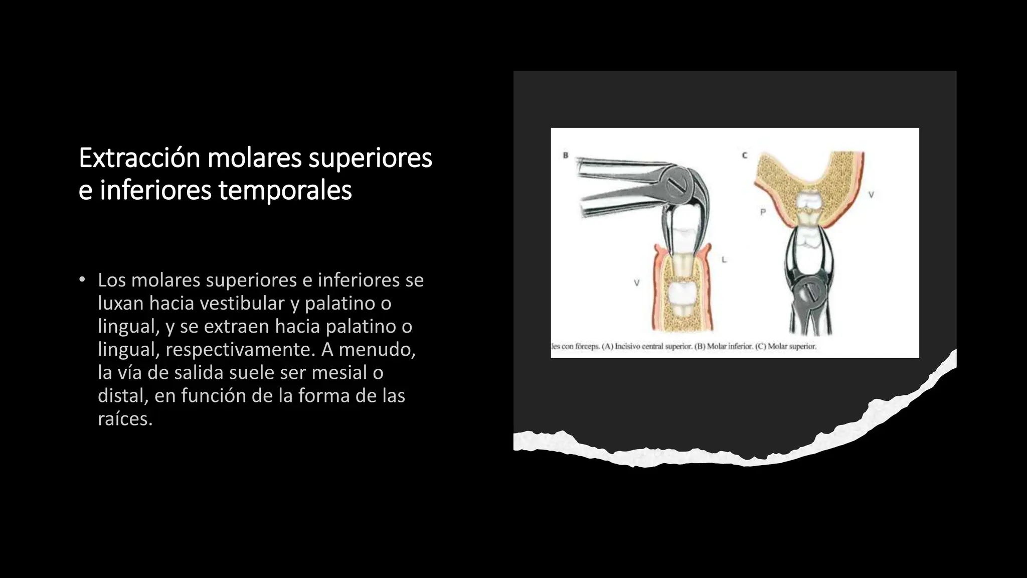 exodoncia de erupcion de dientes ectopicos | PPT