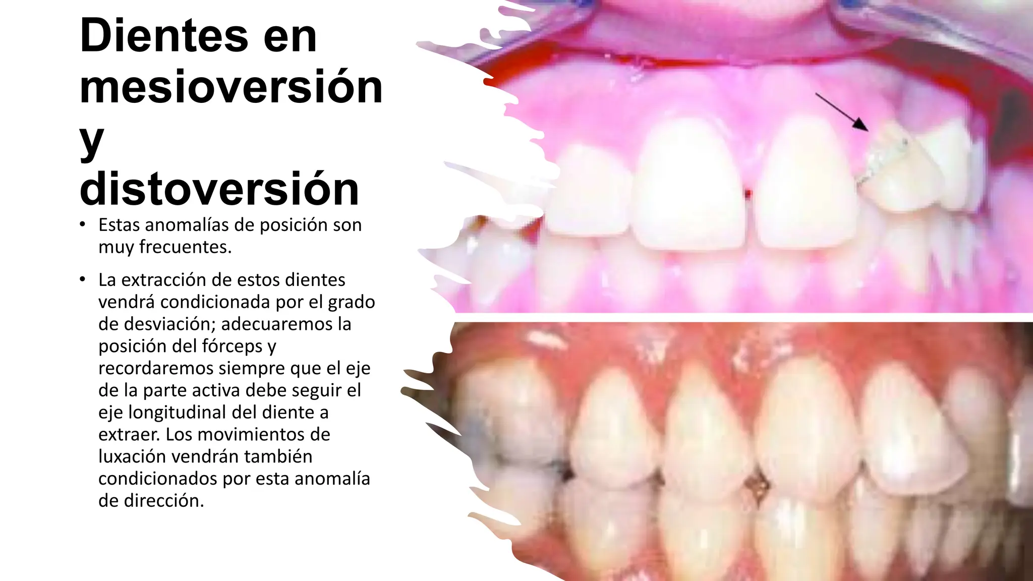 exodoncia de erupcion de dientes ectopicos | PPT