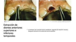 exodoncia de erupcion de dientes ectopicos | PPTX