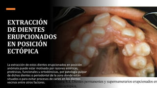 exodoncia de erupcion de dientes ectopicos | PPTX