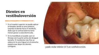 exodoncia de erupcion de dientes ectopicos | PPTX