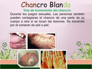 enfermedades de transmicion sexual | PPTX