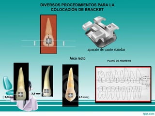 COLOCACION BRACKETS ORTODONCIA | PPTX