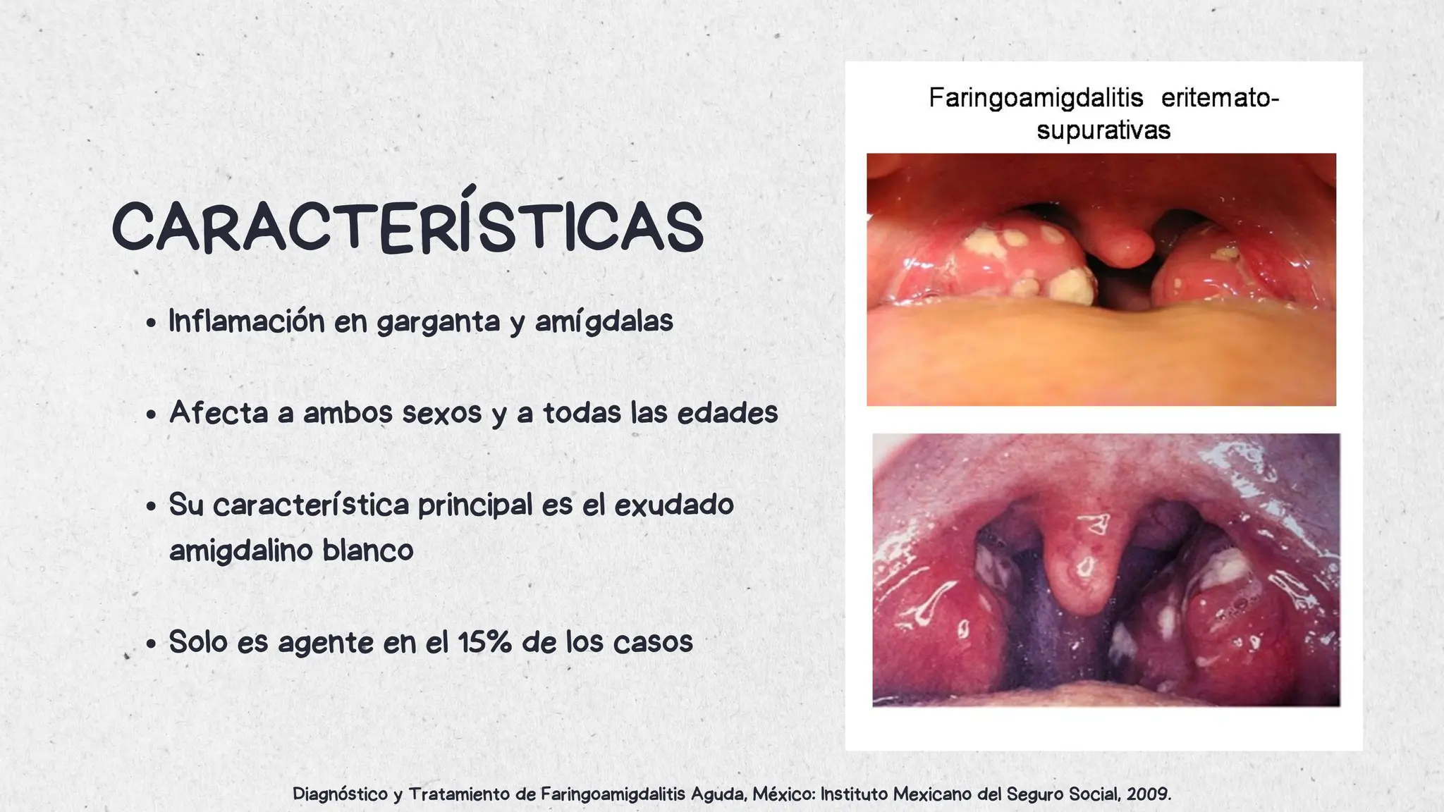 EXPOSICION DE FARINGOAMIGDALITIS AGUDA POR STREPTOCOCCUS PYOGENES | PDF