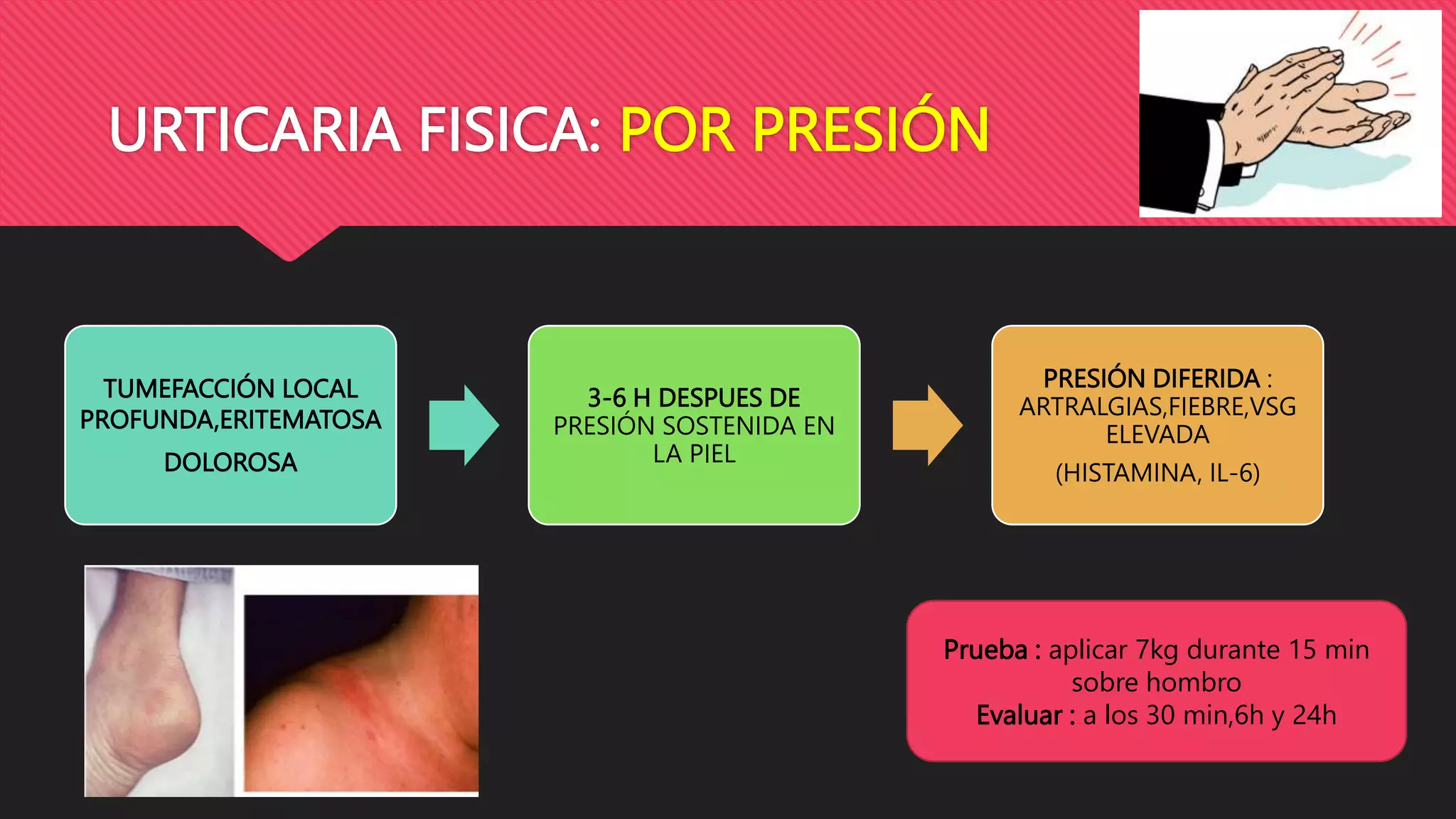 EXPO DE URTICARIA.pptx