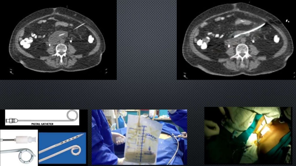 Expo drenaje percutaneo de abdomen