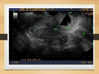 Expo embarazo ectopico cervical 2015 | PPT | Pregnancy | Reproductive ...