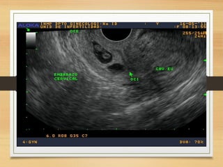 Expo embarazo ectopico cervical 2015 | PPT | Pregnancy | Reproductive ...
