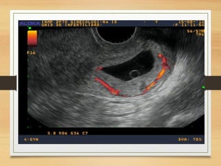Expo embarazo ectopico cervical 2015 | PPT | Pregnancy | Reproductive ...
