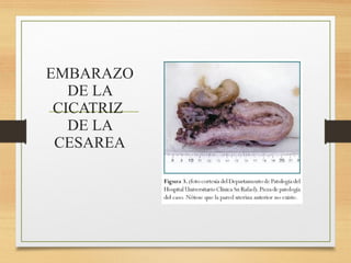 Expo embarazo ectopico cervical 2015 | PPT | Pregnancy | Reproductive ...