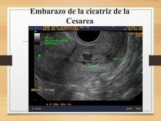Expo embarazo ectopico cervical 2015 | PPT