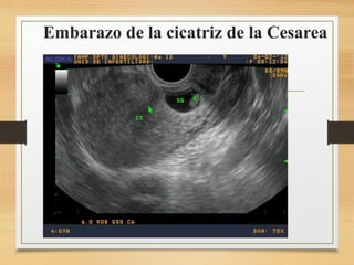 Expo embarazo ectopico cervical 2015 | PPT | Pregnancy | Reproductive ...