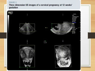 Expo embarazo ectopico cervical 2015 | PPT