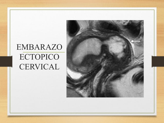Expo embarazo ectopico cervical 2015 | PPT