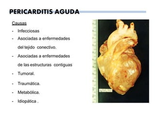 Expo enfermedad pericardio | PPTX