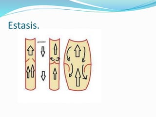trombosis venosa profunda | PPTX