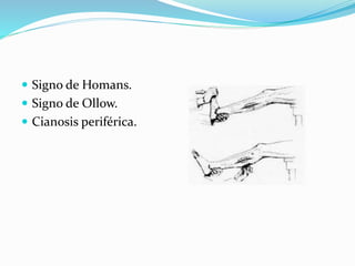 trombosis venosa profunda | PPTX