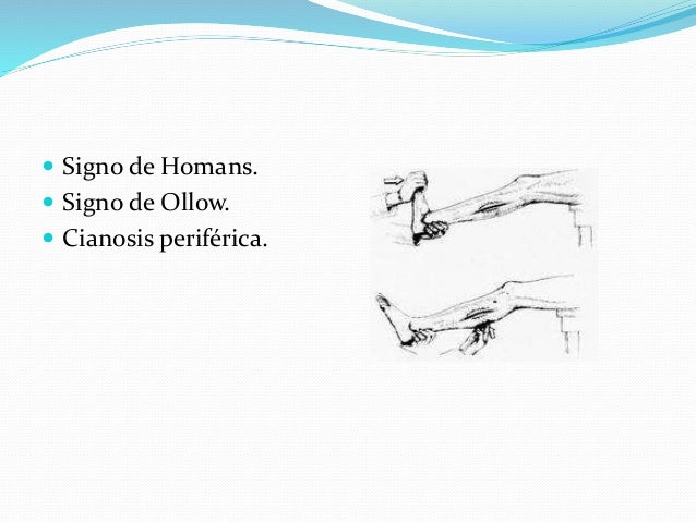 trombosis venosa profunda