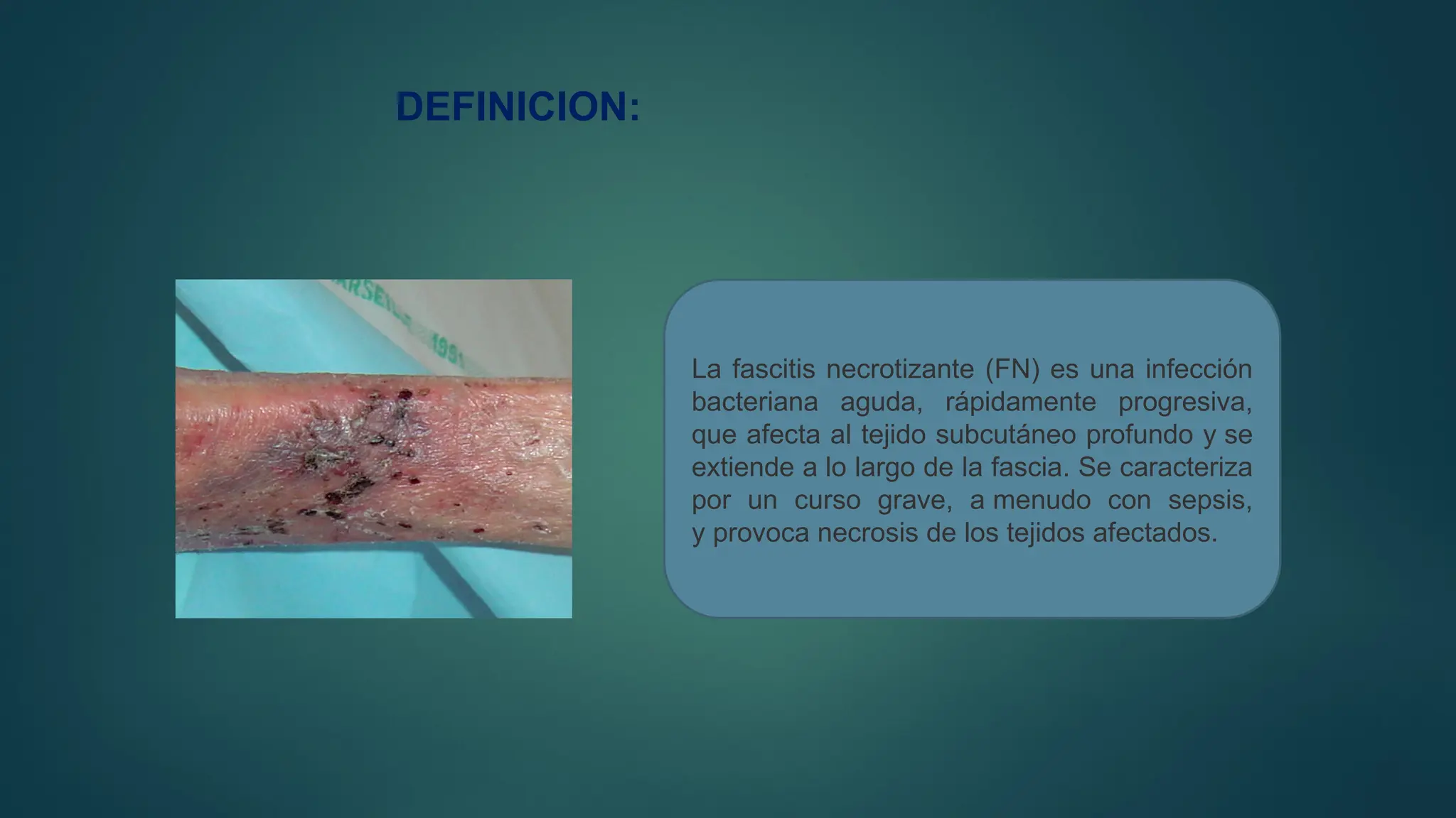 Caso Clinico De Enfermeria Fascitis Necrotizantepptx 6162