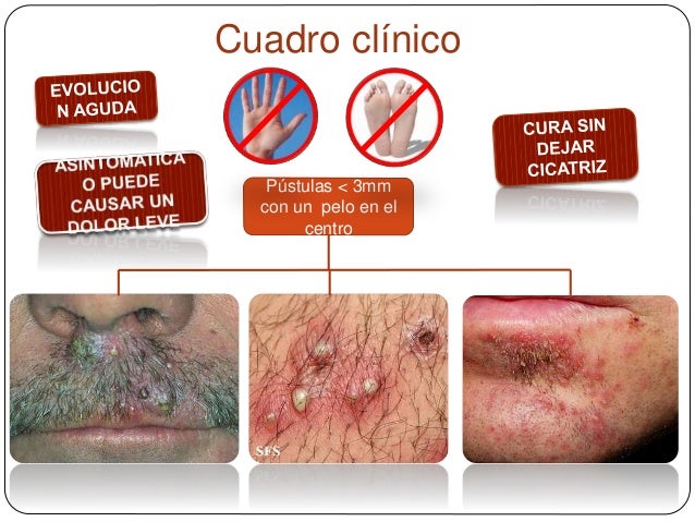 Foliculitis