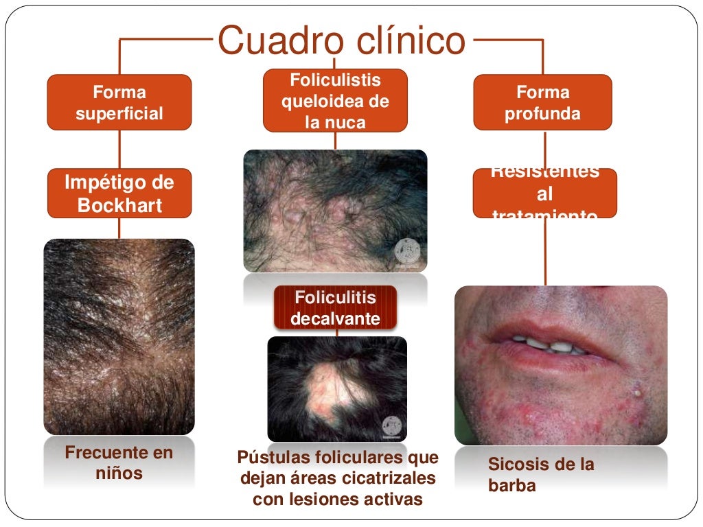 FOLICULITIS