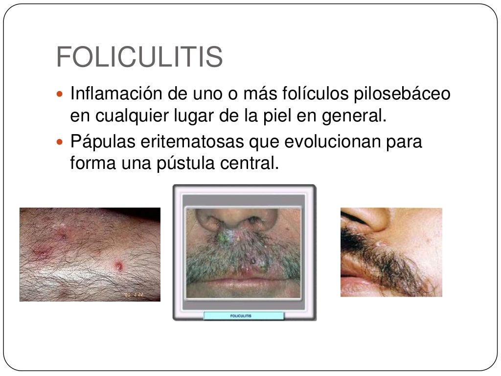 Expo foliculitis