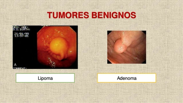 gastrologia tumor del intestino delgado