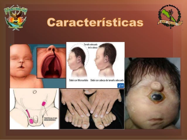 genetica de la trisomia 21 y otras anomalias