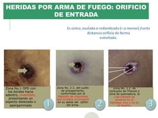 Heridas De Entrada Y Salida Por Arma De Fuego