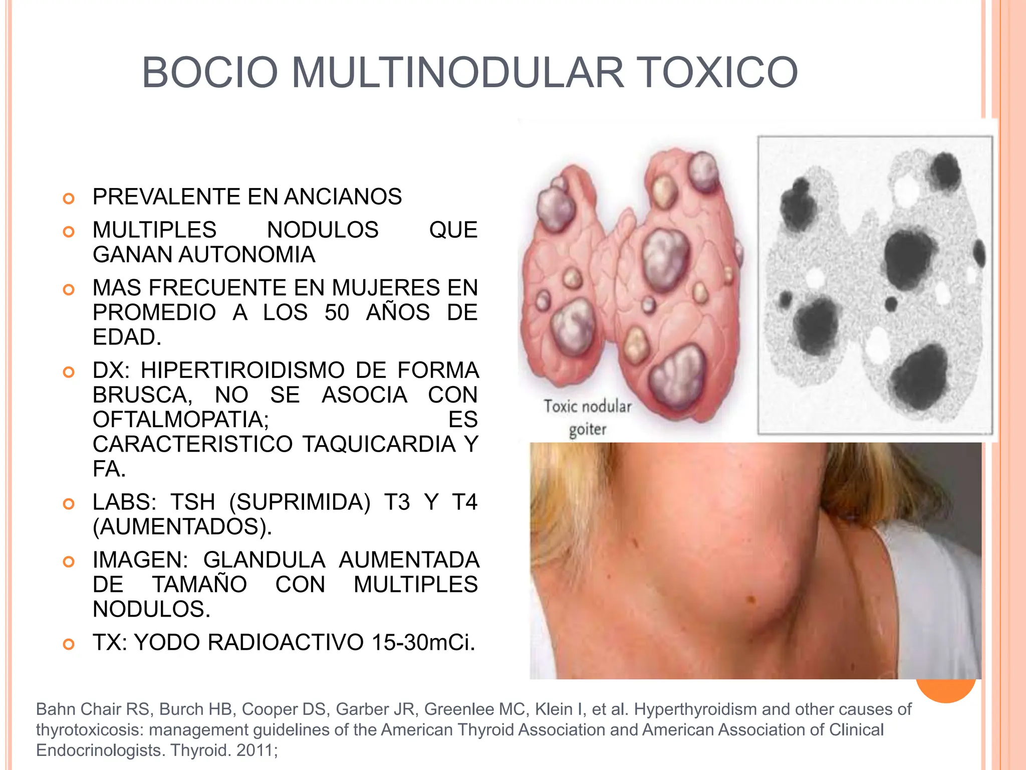 EXPO HIPERTIROIDISMO, definicion, dignostico y tratamiento | PPTX