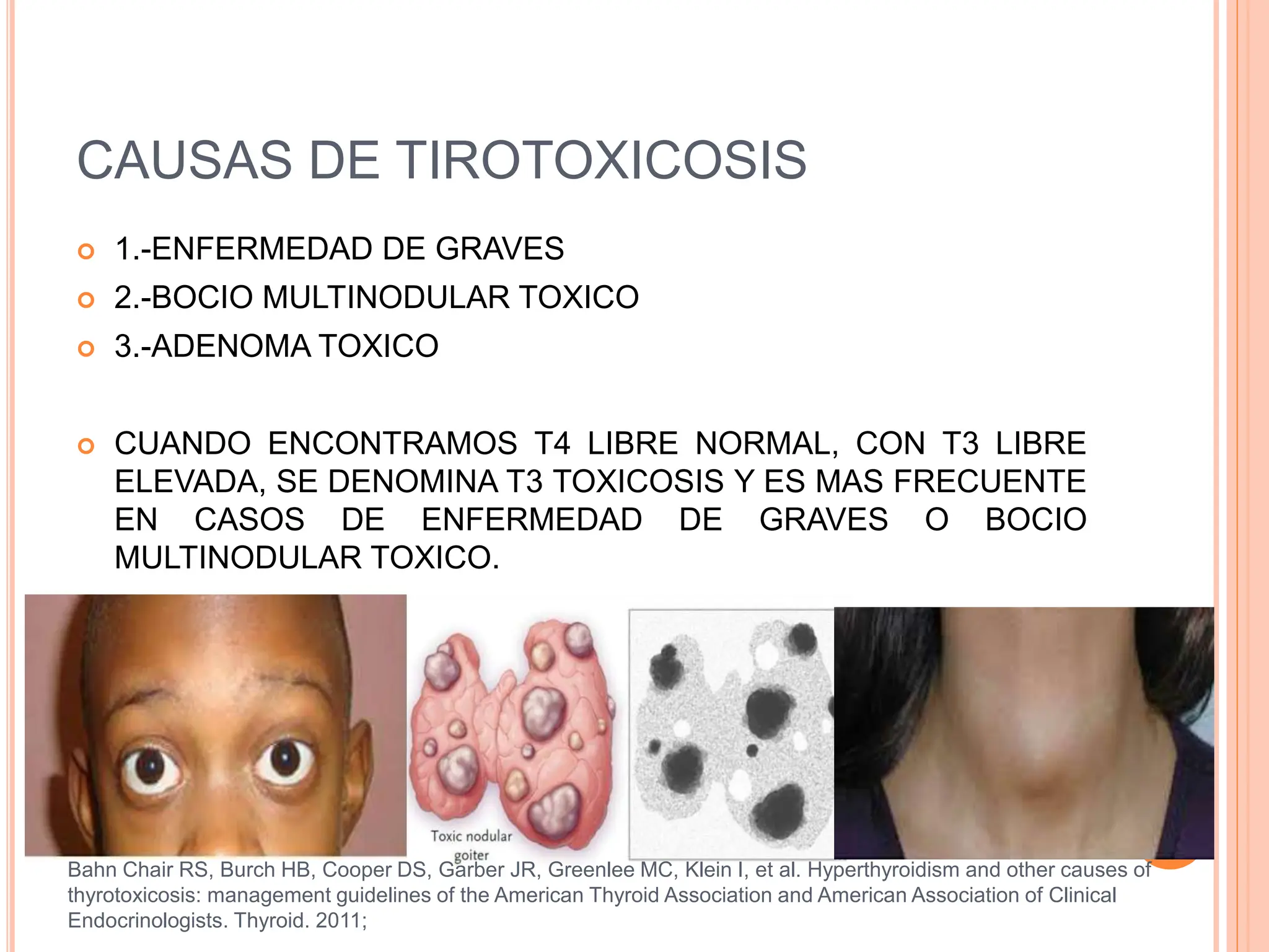 EXPO HIPERTIROIDISMO, definicion, dignostico y tratamiento | PPTX
