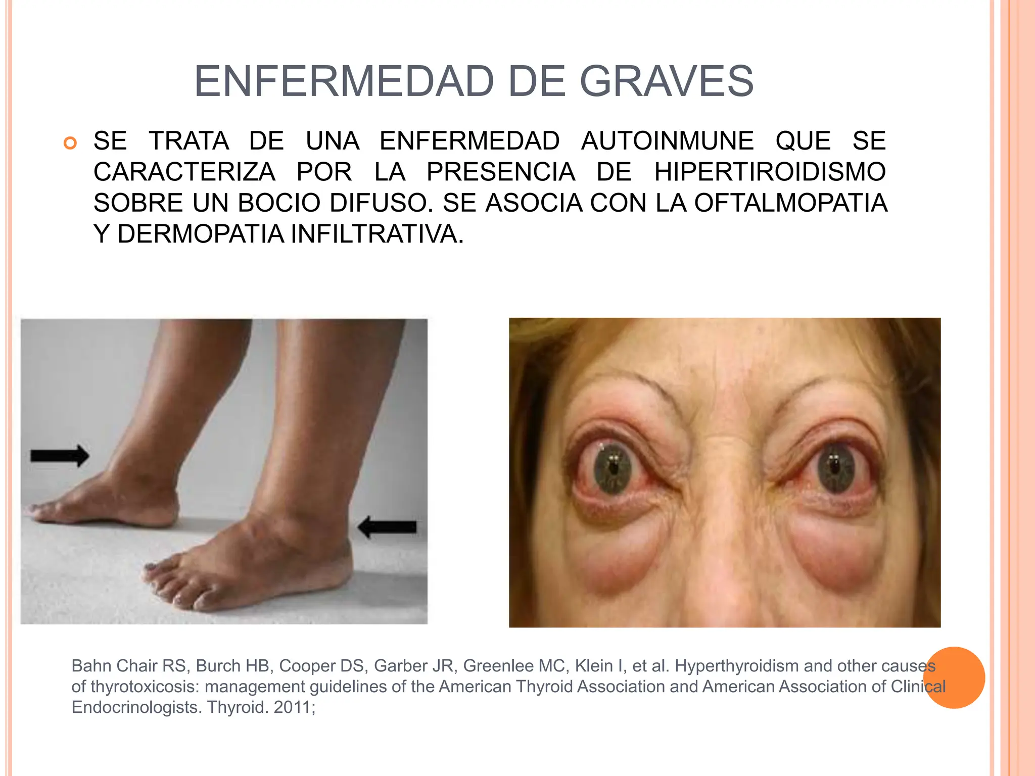 EXPO HIPERTIROIDISMO, definicion, dignostico y tratamiento | PPTX