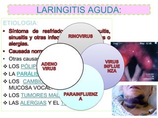 Expo laringitis aguda | PPTX