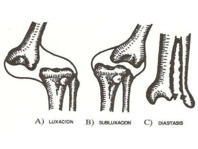 Luxaciones
