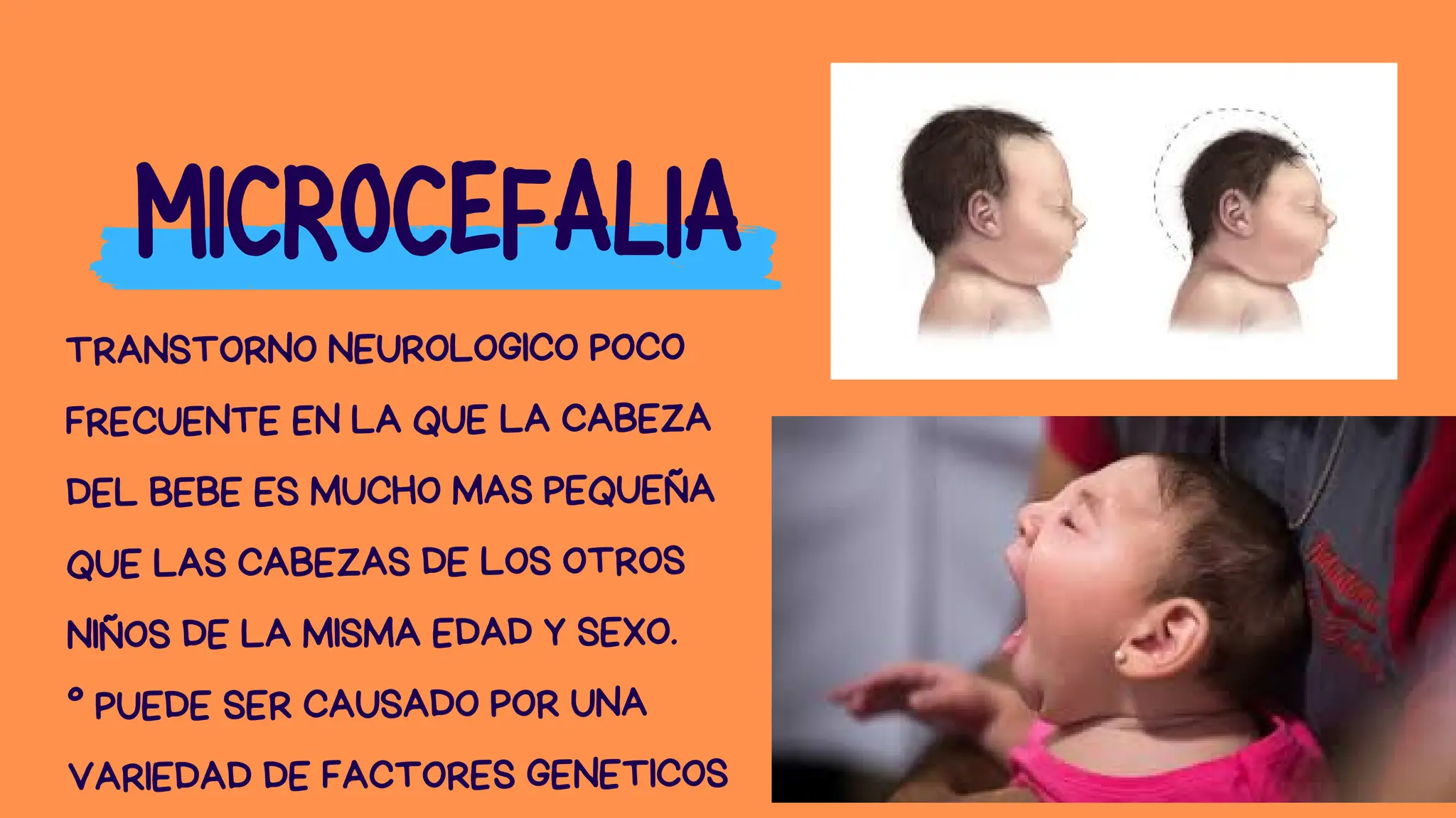 Hidrocefalia ,macrocefalia, microcefalia, | PPT