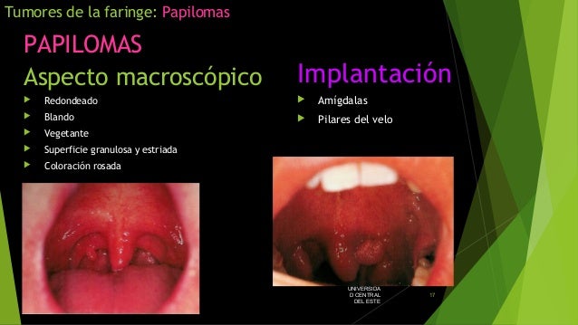 TUMORES DE LA FARINGE