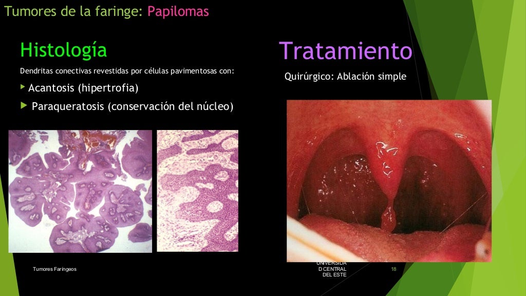 TUMORES DE LA FARINGE
