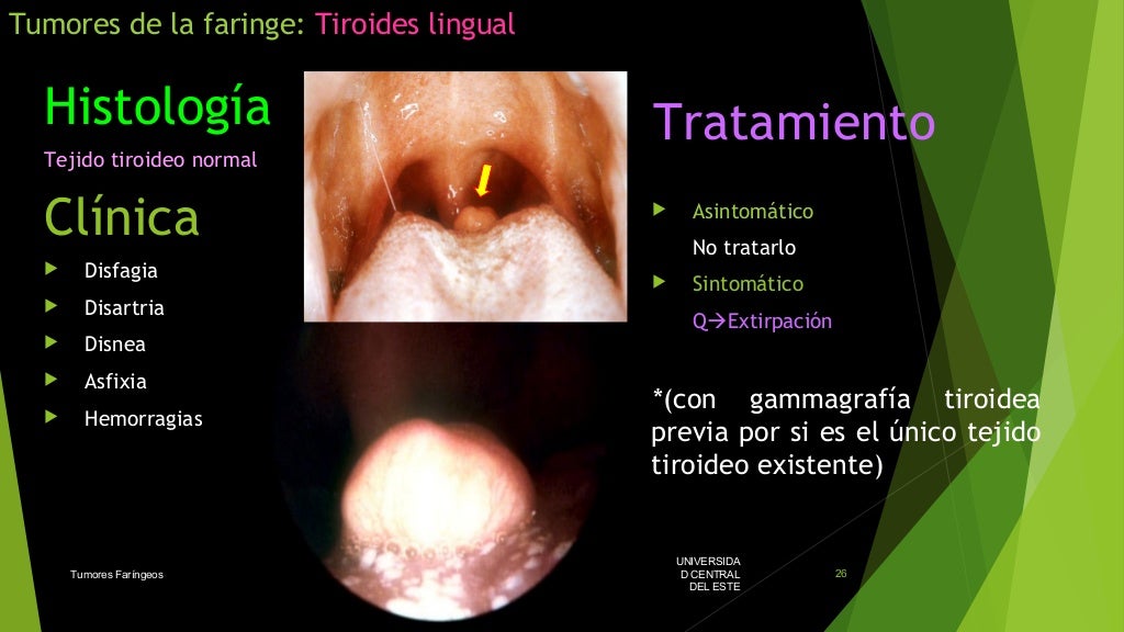 TUMORES DE LA FARINGE