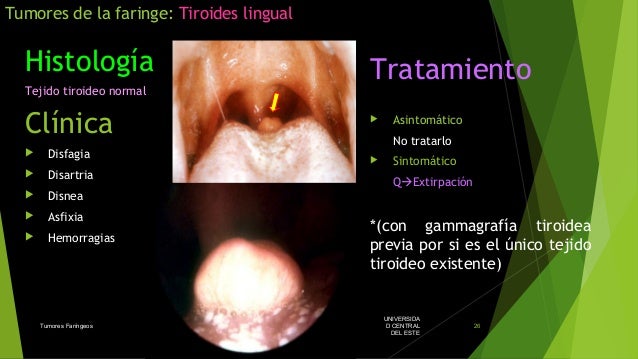 TUMORES DE LA FARINGE