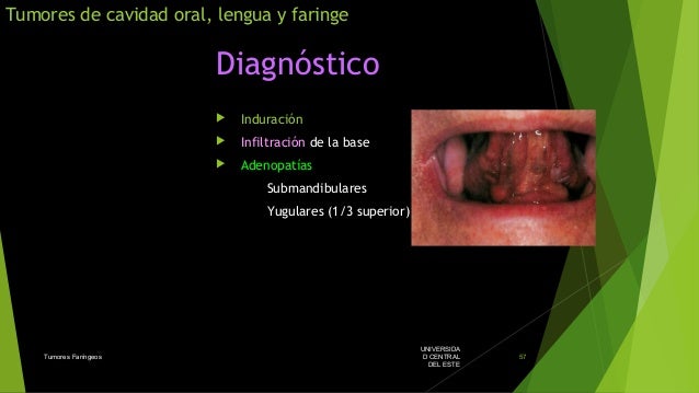 TUMORES DE LA FARINGE