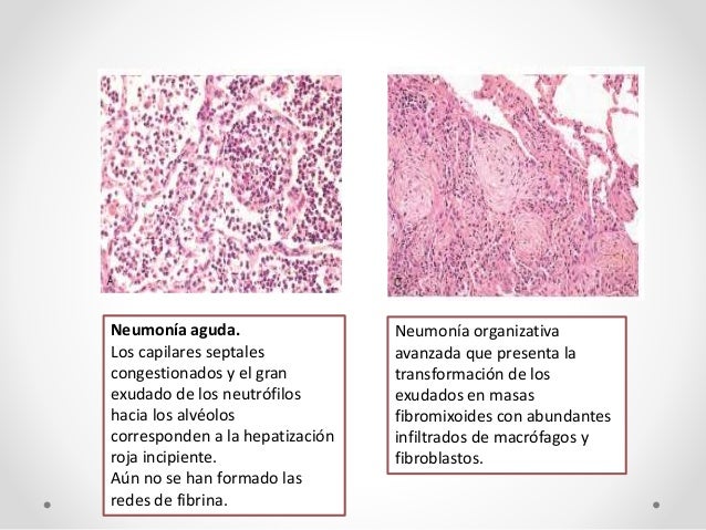 Neumonía y Tuberculosis (Patología)