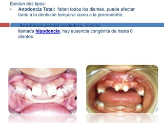 ALTERACIONES DEL DESARROLLO DENTAL EN RELACION AL NUMERO | PPTX