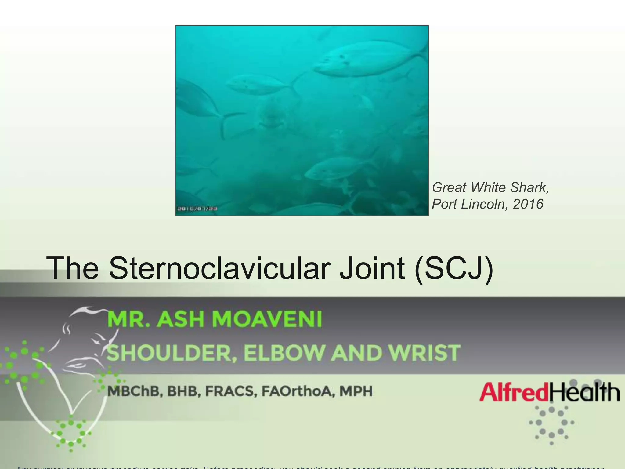 The Sternoclavicular Joint | PPTX
