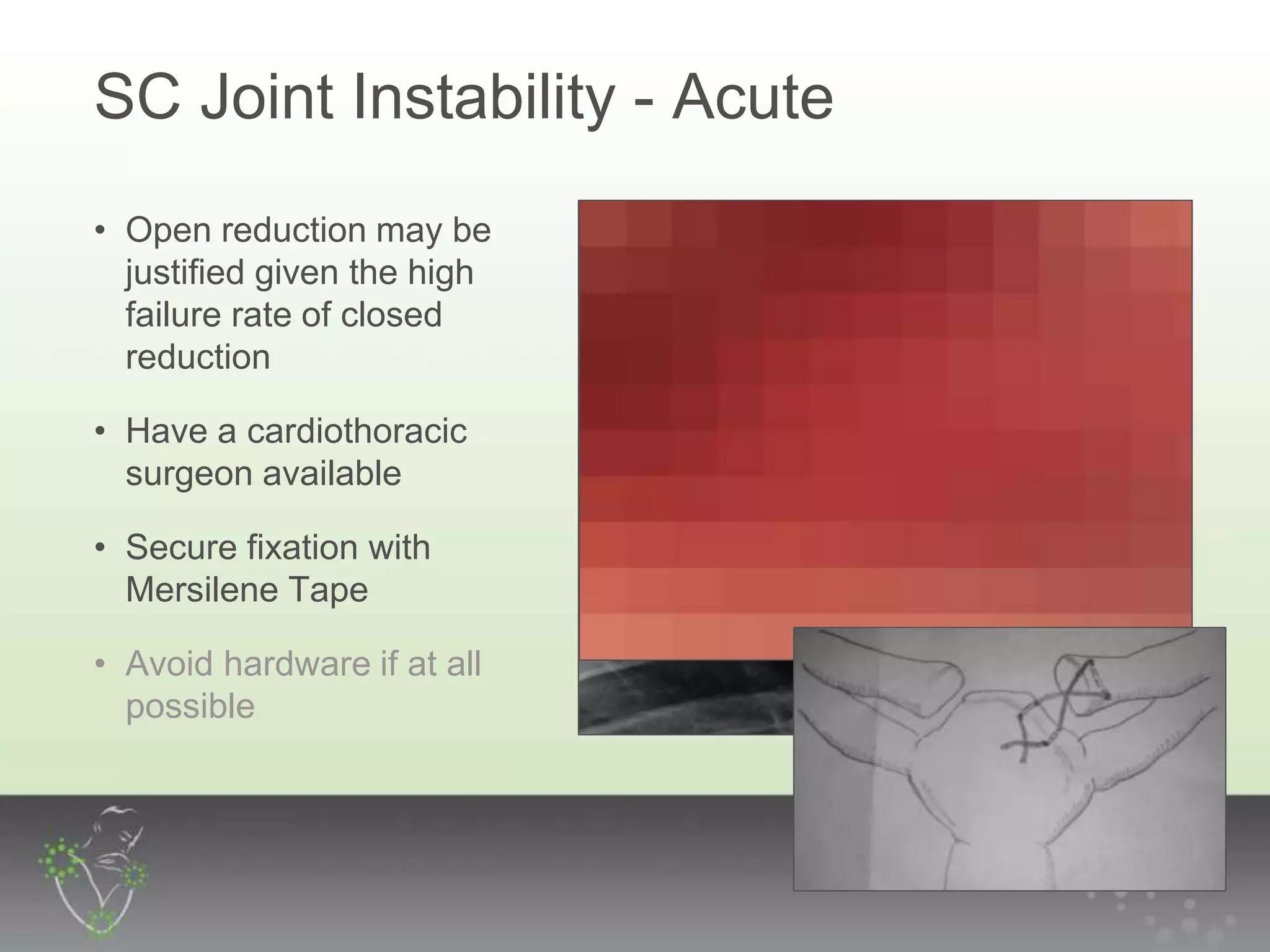 The Sternoclavicular Joint | PPTX