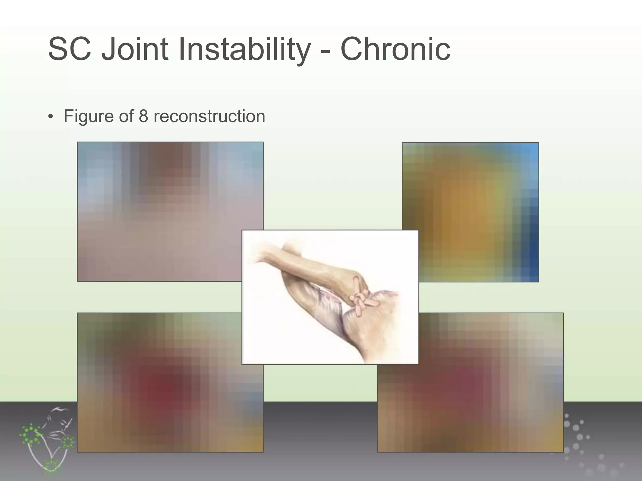 The Sternoclavicular Joint | PPTX