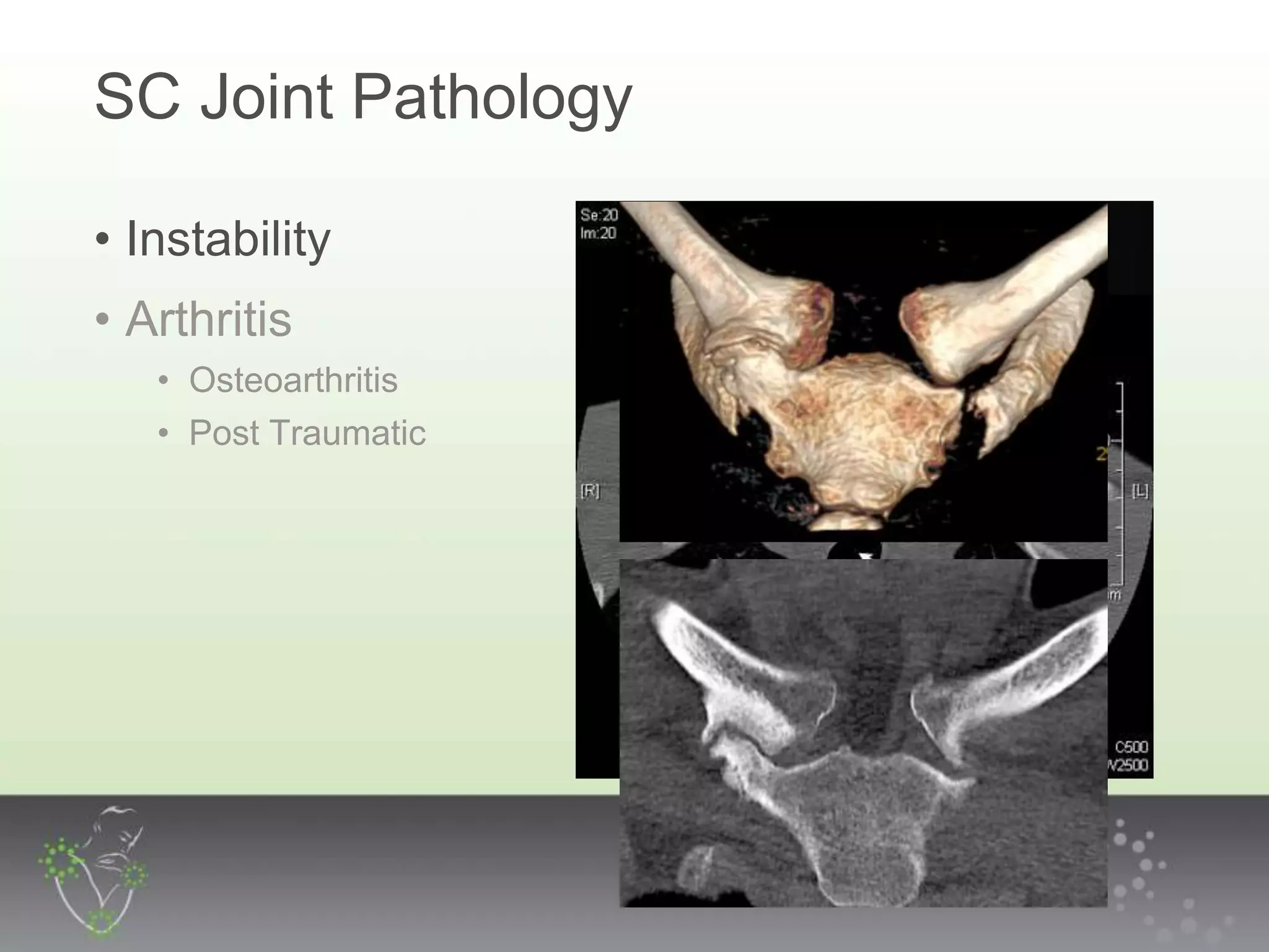The Sternoclavicular Joint | PPTX